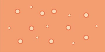 36 bekræftede tilfælde af abekopper (monkeypox) i Europa